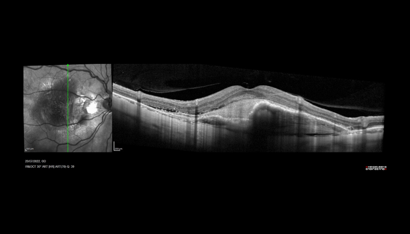 Degenerescência Macular da Idade (DMI) - Instituto de Retina de Lisboa