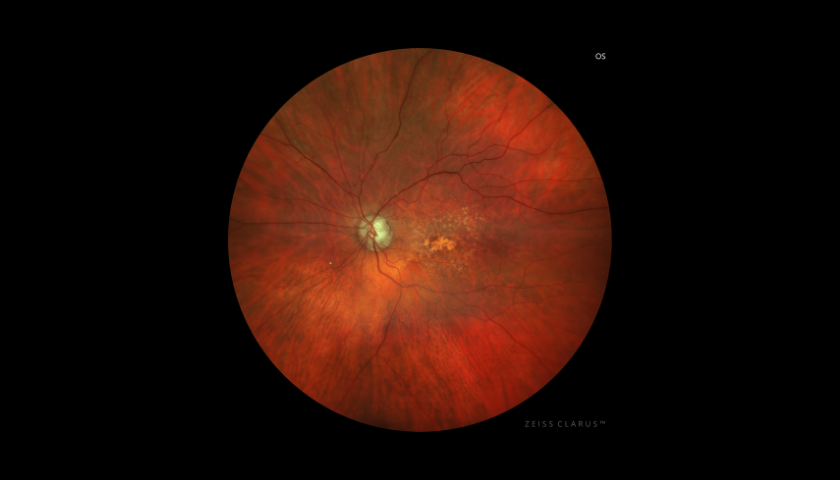 Degenerescência Macular da Idade (DMI) - Instituto de Retina de Lisboa